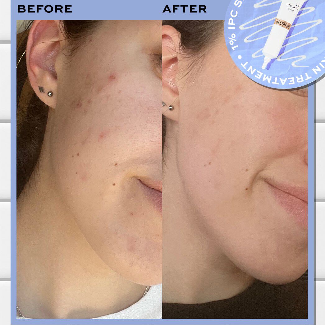 Revolution Skincare 1% IPC Blemish Treatment Serum | Revolution Beauty